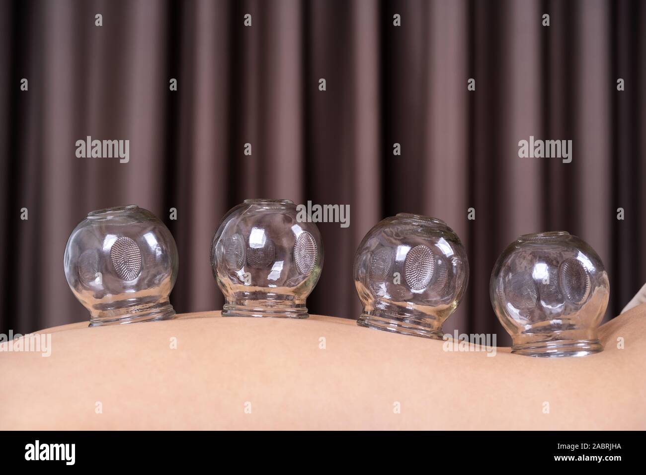 young woman receiving cupping treatment on back Stock Photo - Alamy