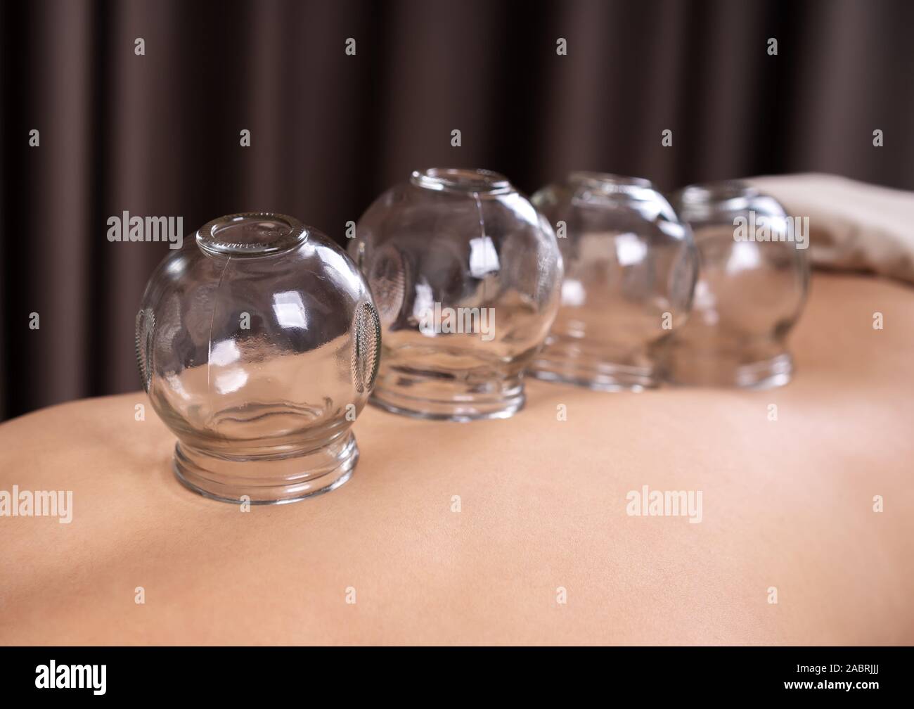 young woman receiving cupping treatment on back Stock Photo - Alamy