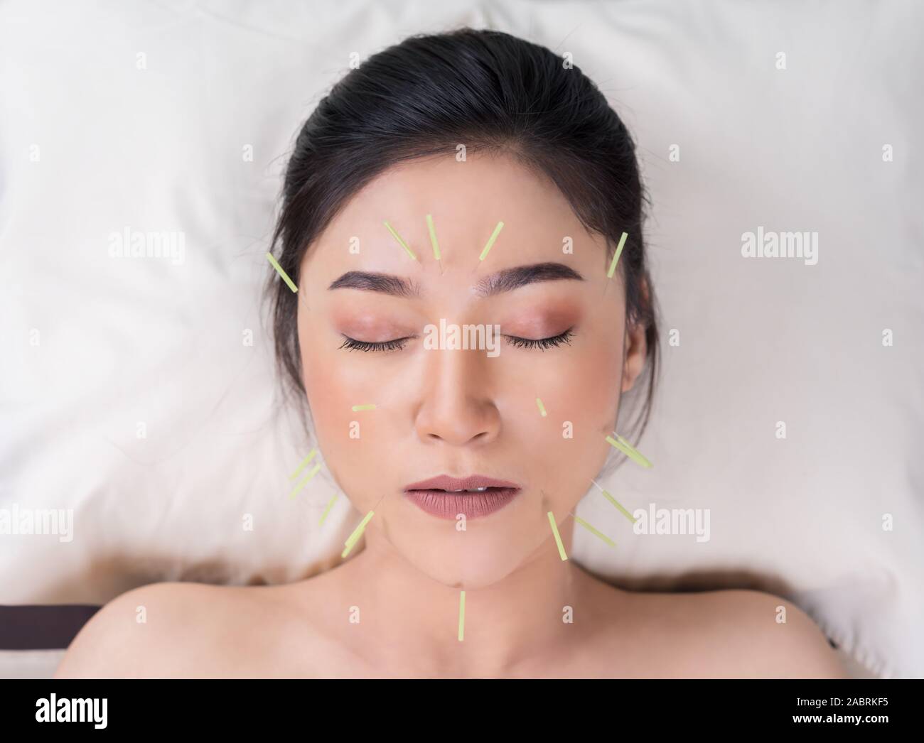 Asian woman undergoing acupuncture beauty hi-res stock photography and ...