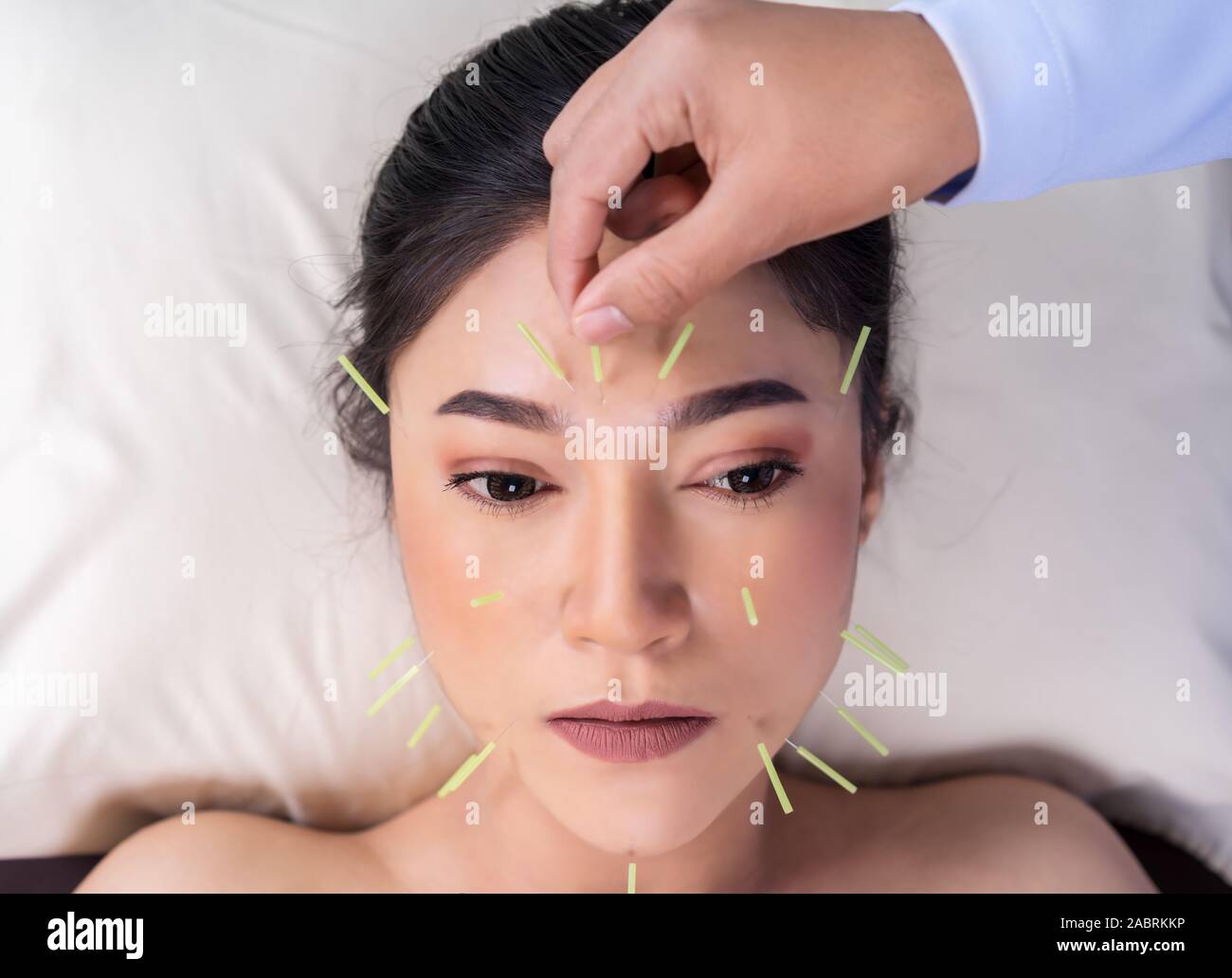 Asian Woman Undergoing Acupuncture Beauty Hi Res Stock Photography And