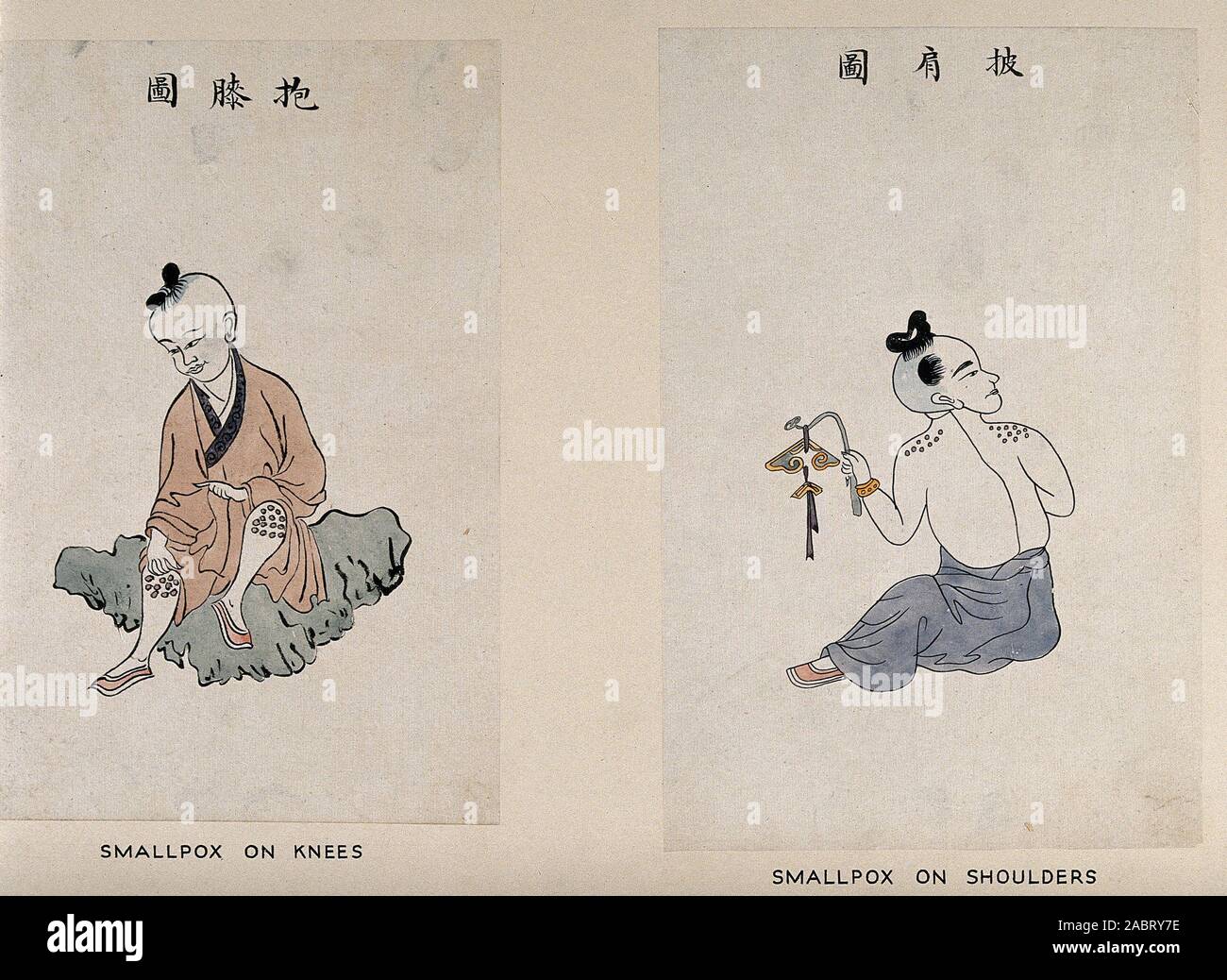 Smallpox 19th Century High Resolution Stock Photography and Images - Alamy