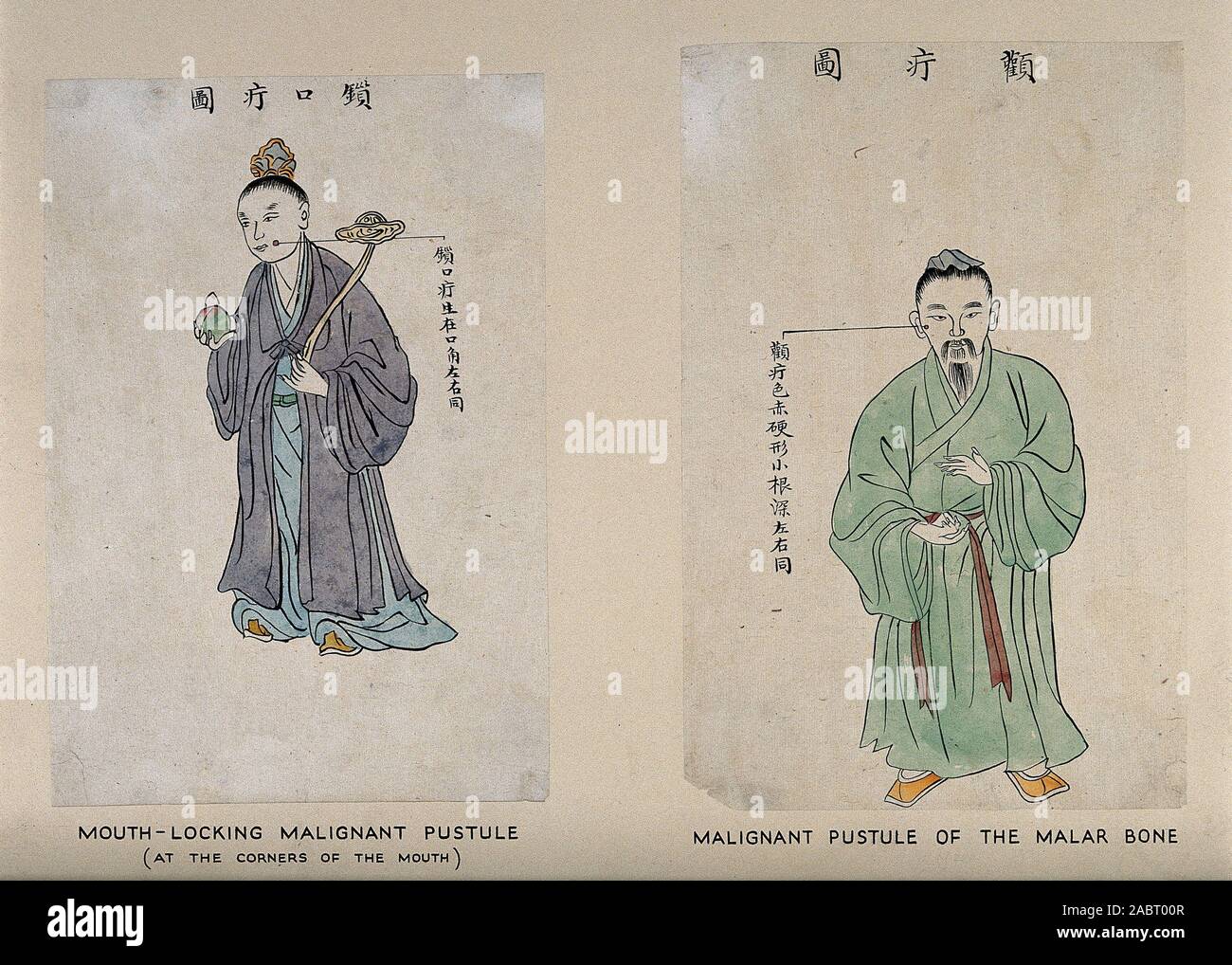 Malignant pustule hi-res stock photography and images - Alamy