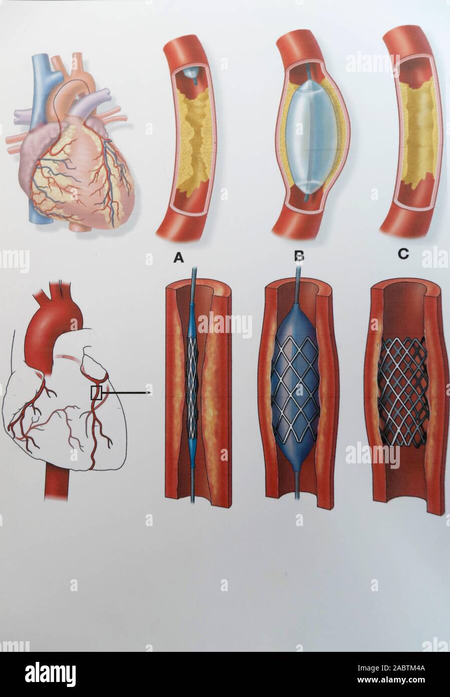 Aortic stenosis hi-res stock photography and images - Alamy
