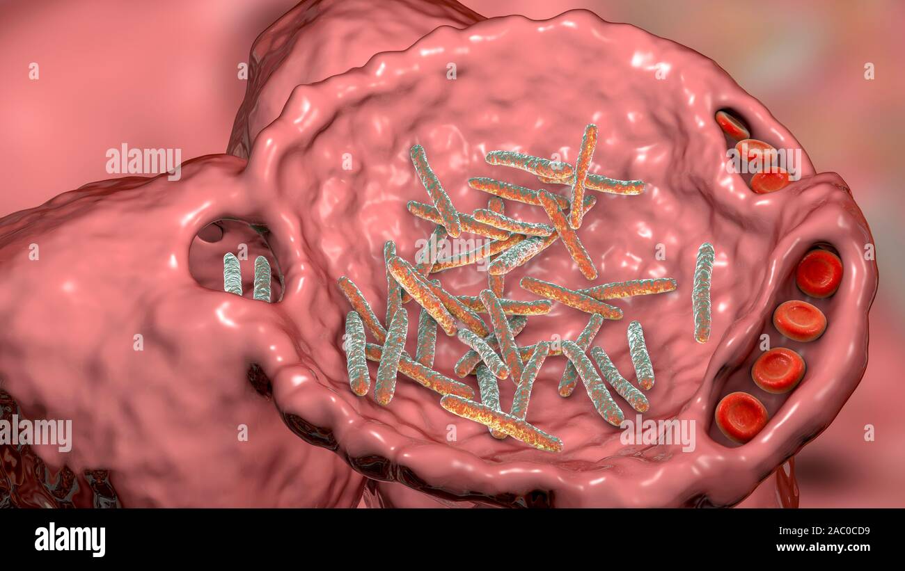 Bacterial pneumonia. Computer illustration of rod-shaped bacteria ...