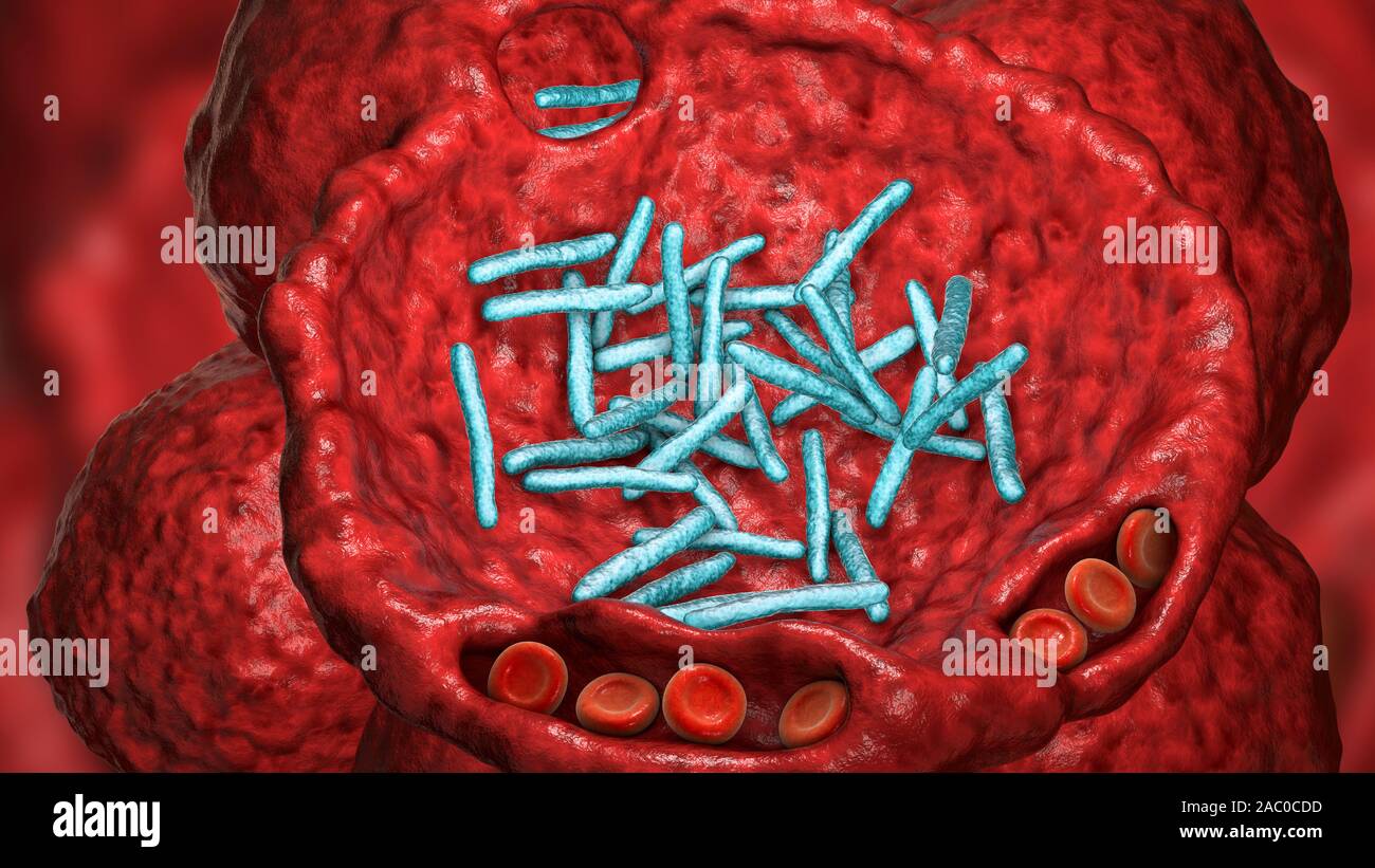 Bacterial pneumonia. Computer illustration of rod-shaped bacteria ...