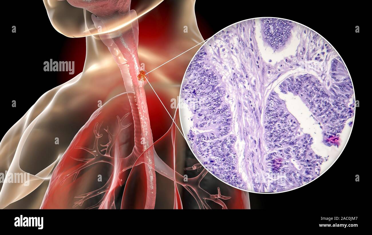 Oesophagus micrograph hi-res stock photography and images - Alamy