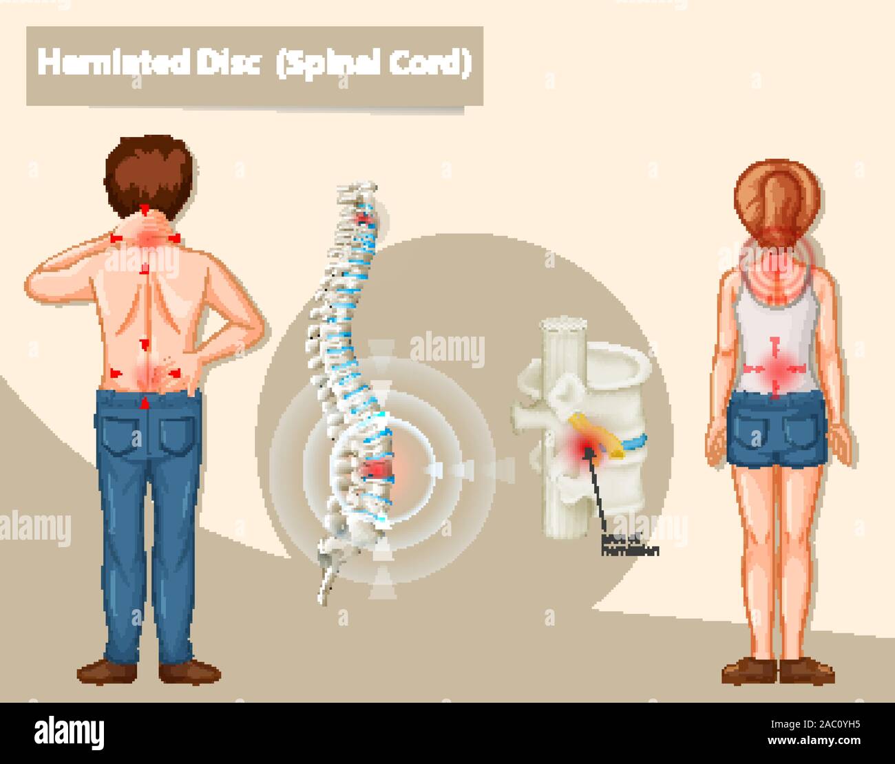 Diagram showing herniated disc in human illustration Stock Vector Image ...