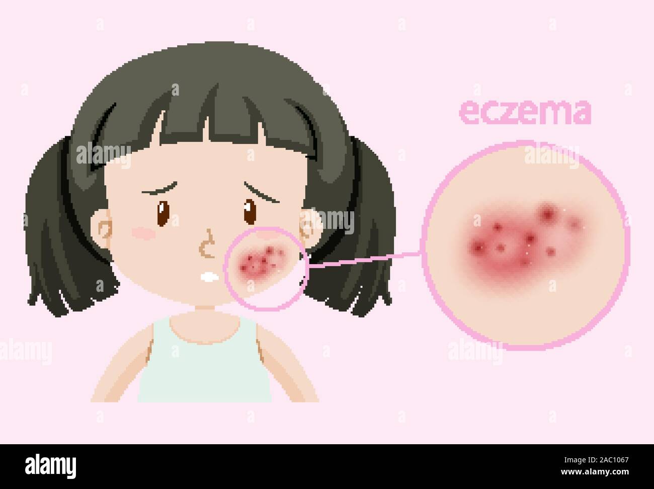 Girl With Eczema On Face Illustration Stock Vector Image And Art Alamy