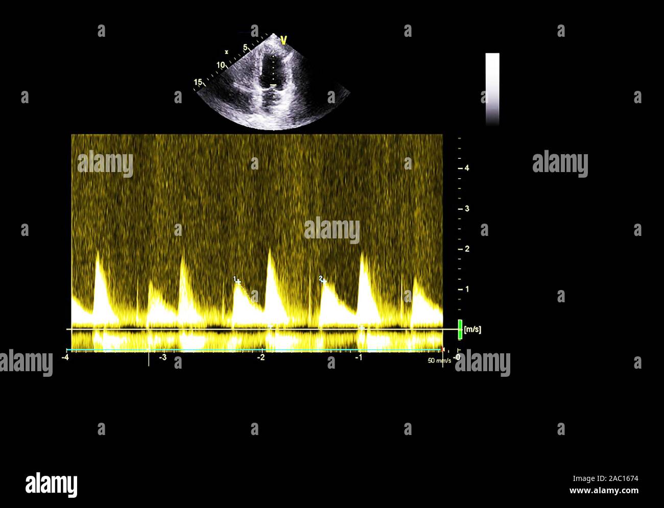 Heart ultrasound procedure hi-res stock photography and images - Alamy