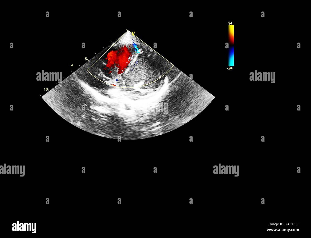 Heart ultrasound procedure hi-res stock photography and images - Alamy