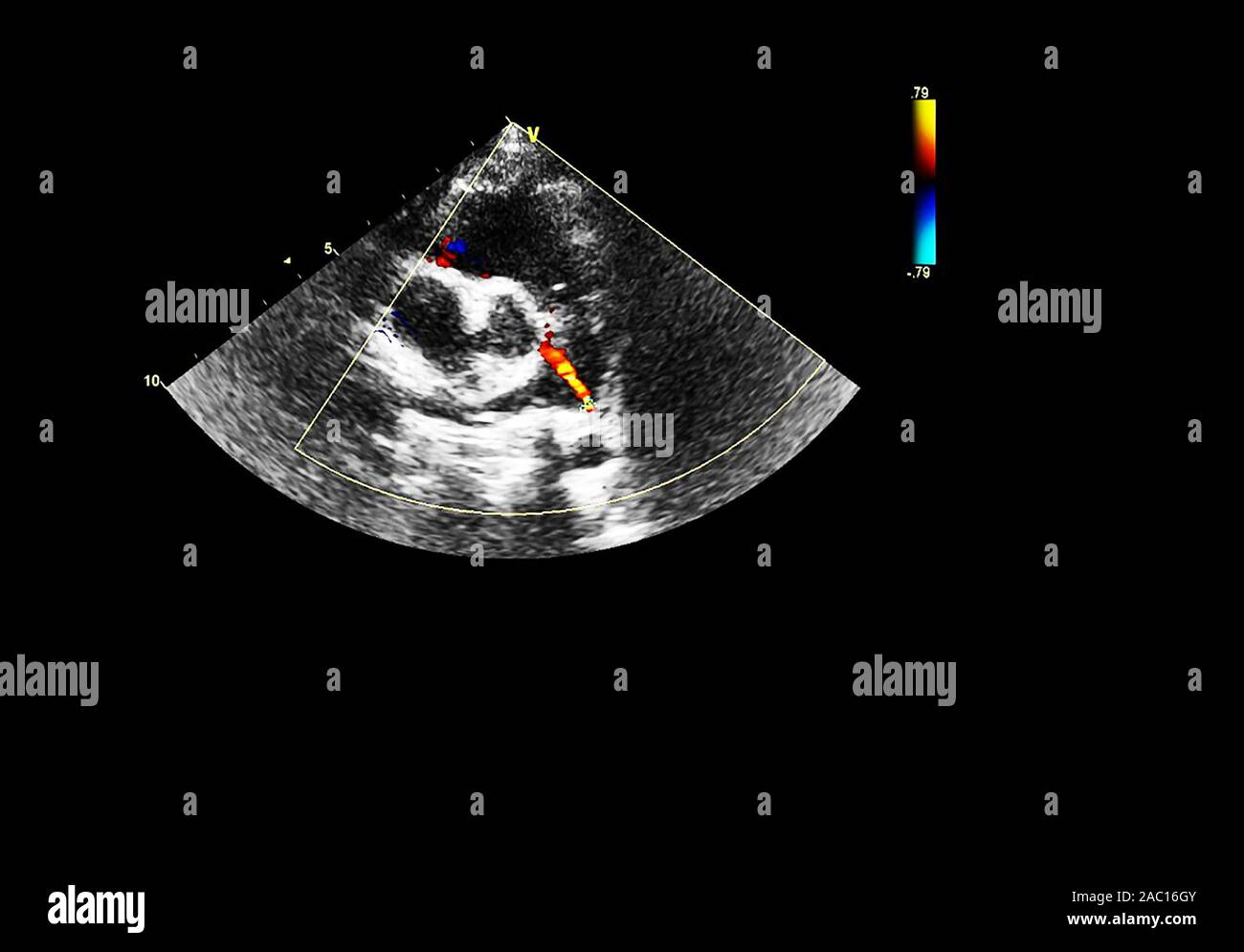 Ultrasound screen with patent ductus arteriosus Stock Photo - Alamy