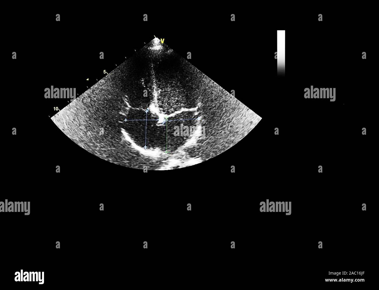 Heart ultrasound procedure hi-res stock photography and images - Alamy