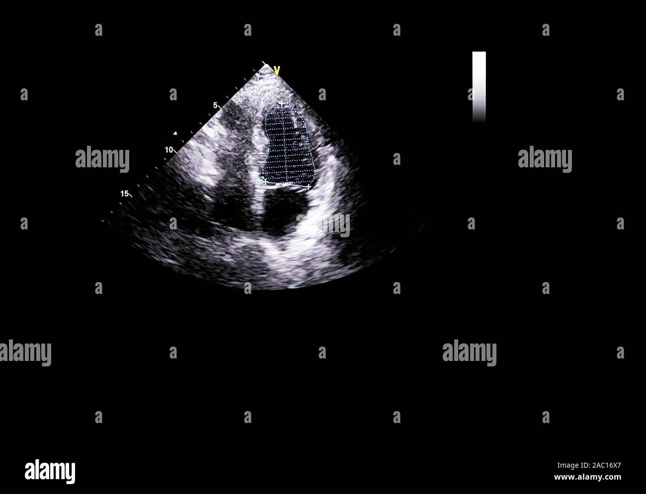 Screen of an ultrasound machine with a heart image Stock Photo - Alamy