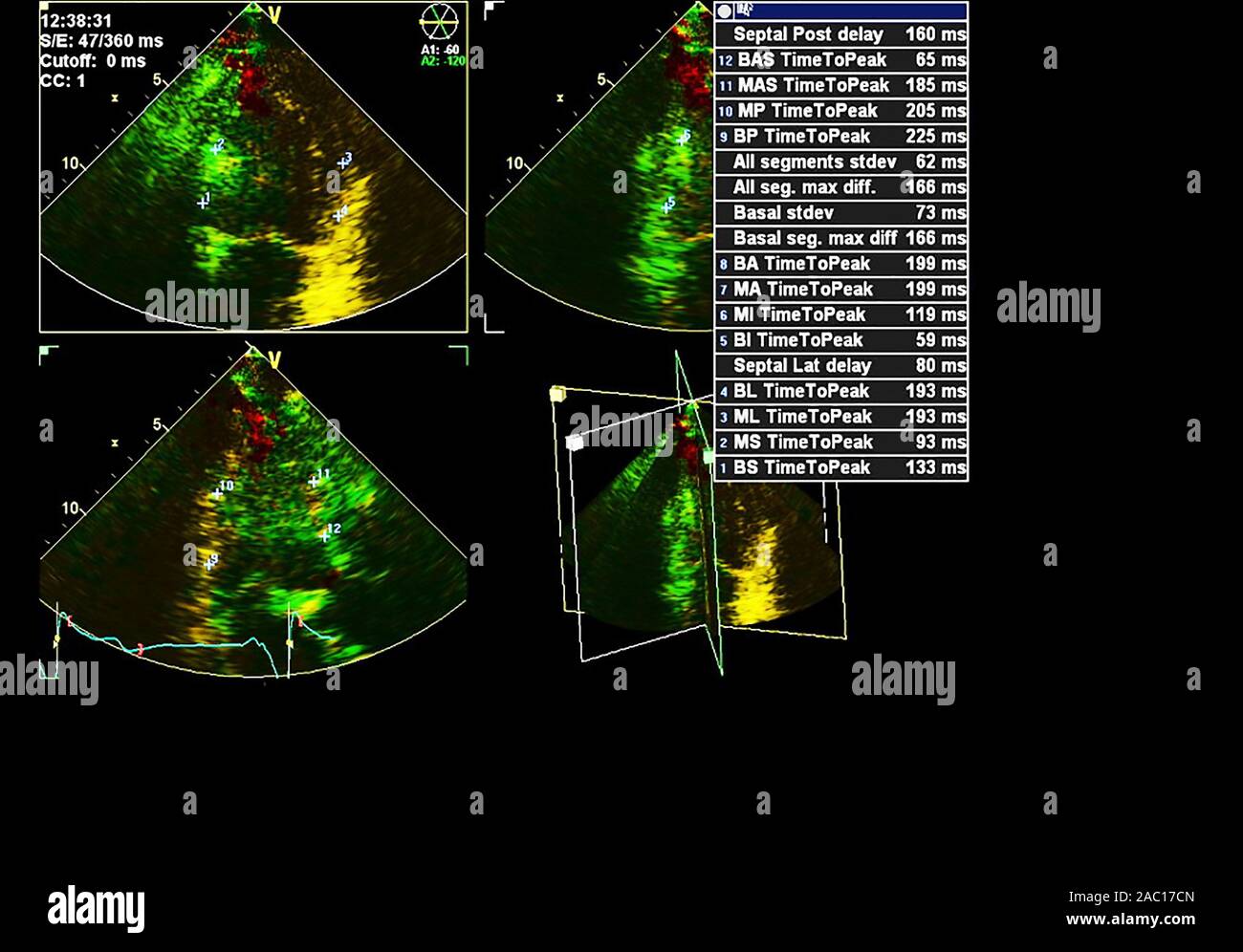 Screen of an ultrasound machine with a heart image Stock Photo - Alamy