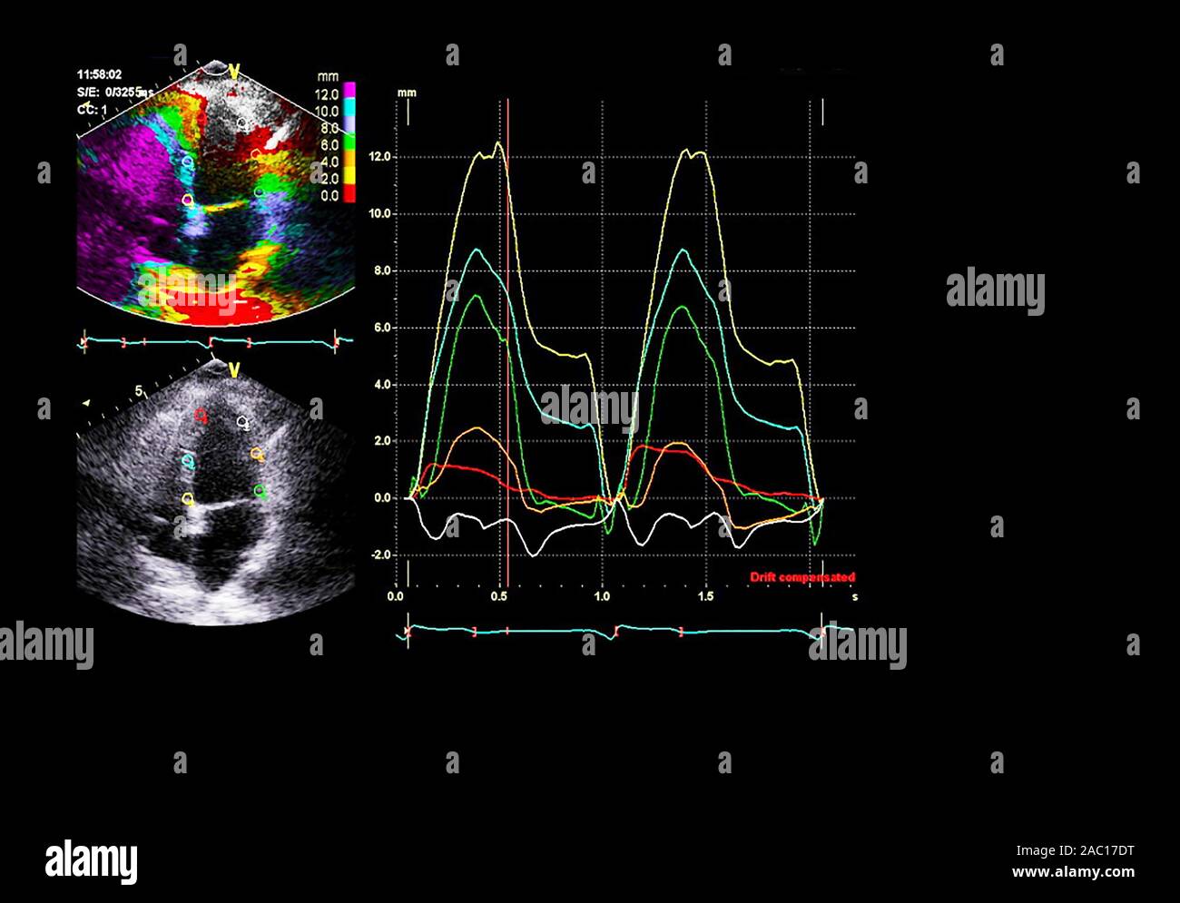 Screen of an ultrasound machine with a heart image Stock Photo - Alamy