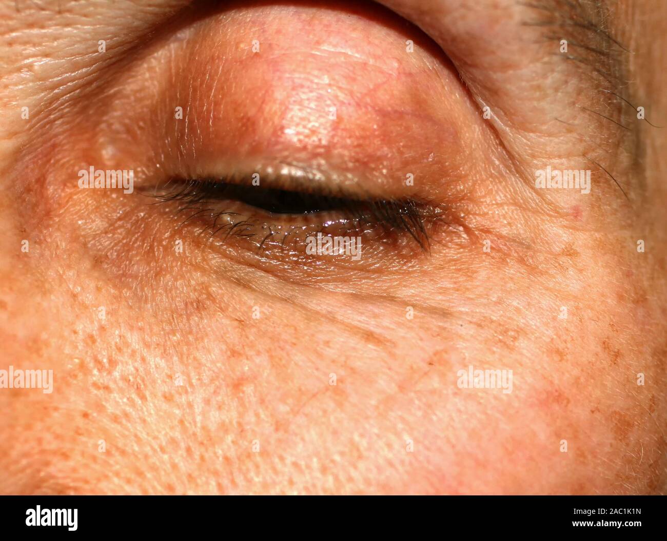 Wrinkles on the eyelids, under the eyes Stock Photo - Alamy