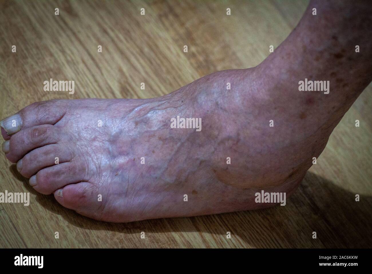 Leprosy Foot