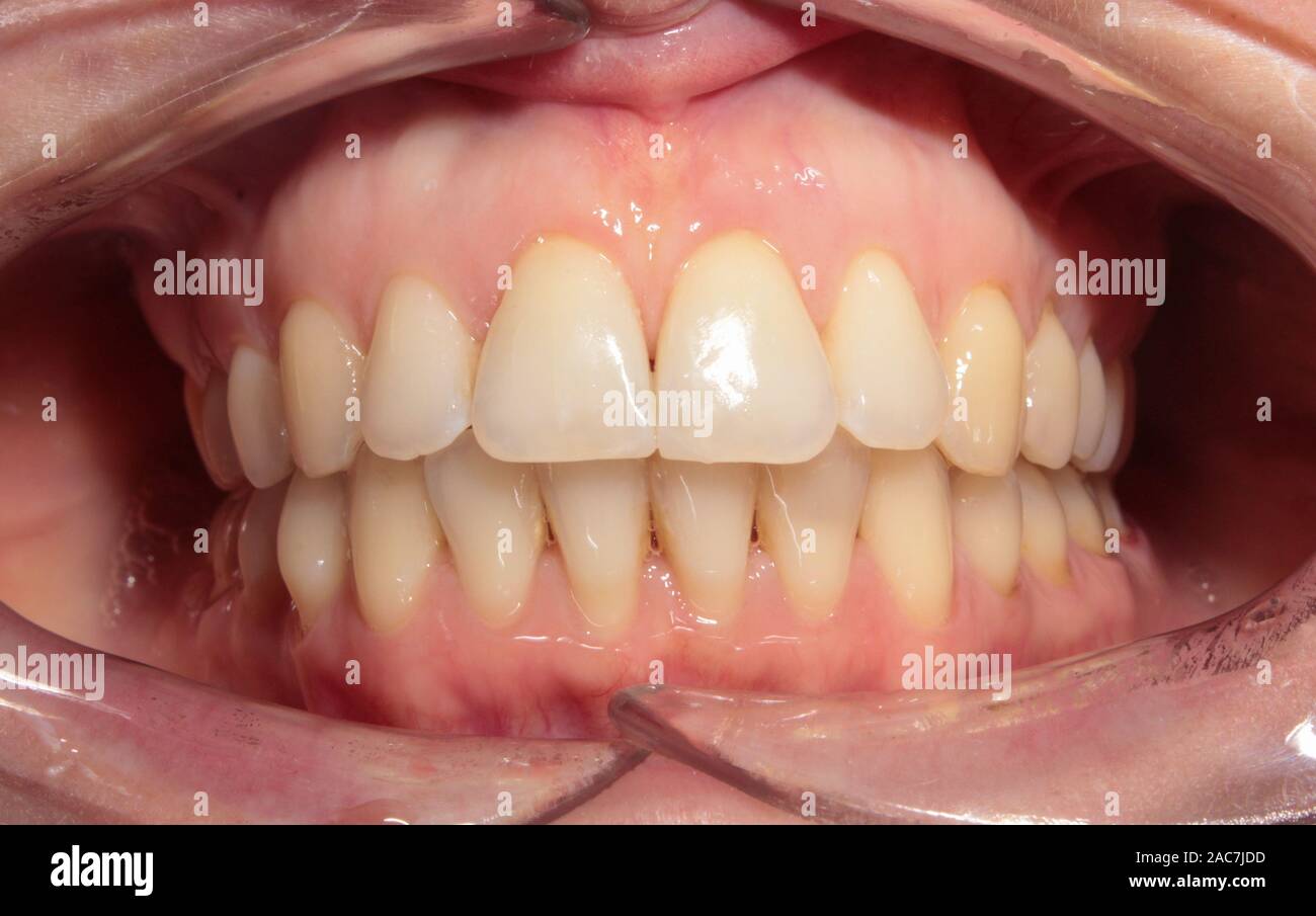 Close-up front view of teeth after correction by dental braces. Photo ...