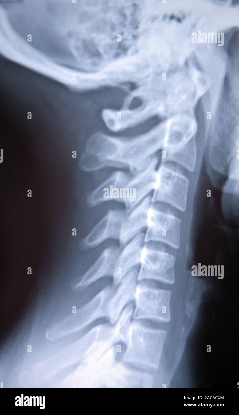 An x-ray image of a spinal column Stock Photo - Alamy