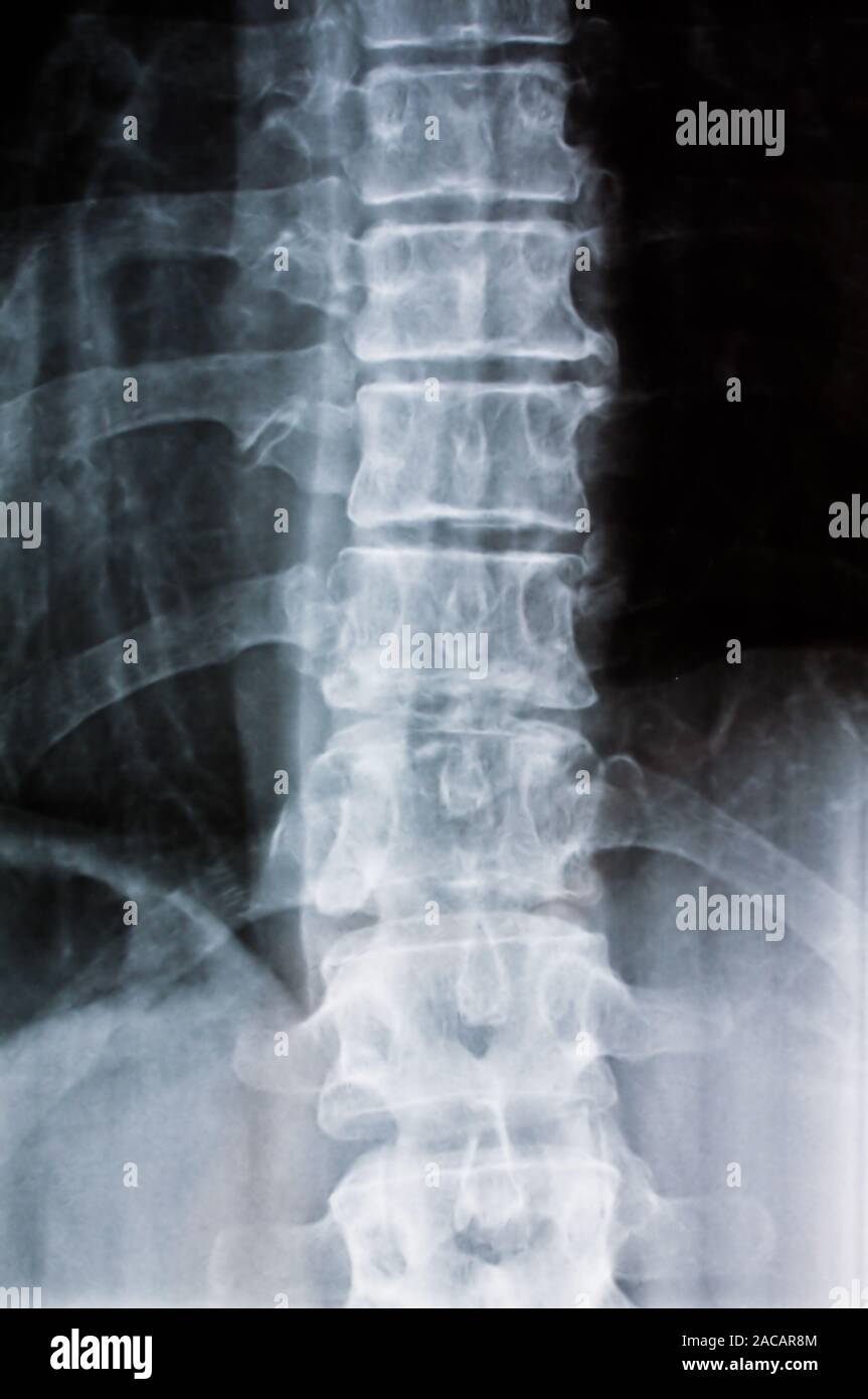 X-ray image of a spinal column Stock Photo - Alamy