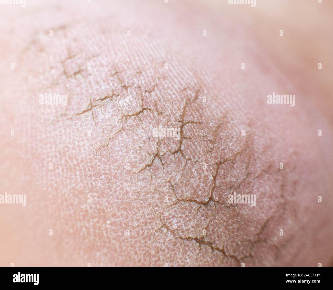 Dry Cracked Skin Stock Photos & Dry Cracked Skin Stock Images - Alamy