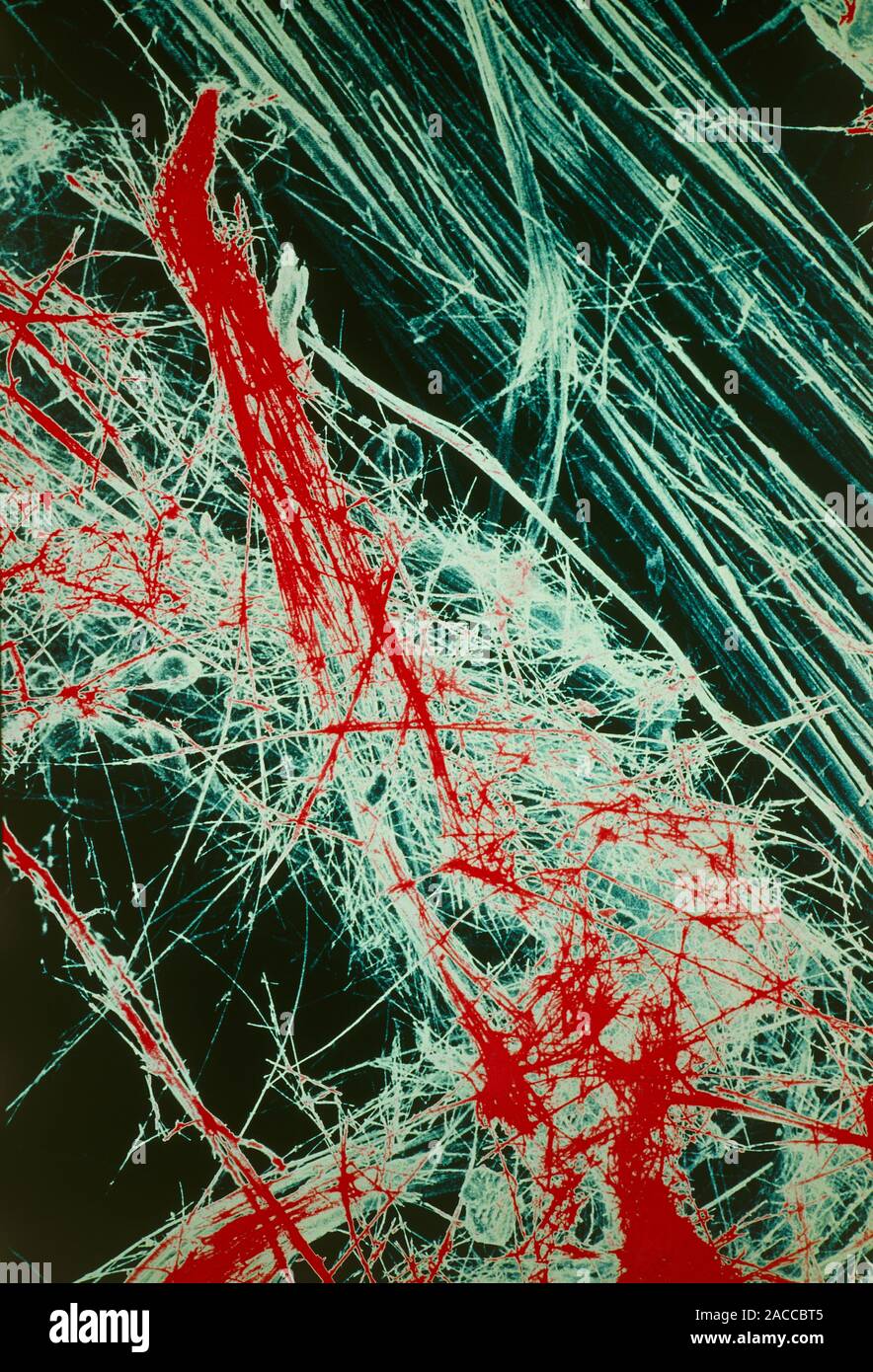 False colour scanning electron micrograph of fibres of blue asbestos ...