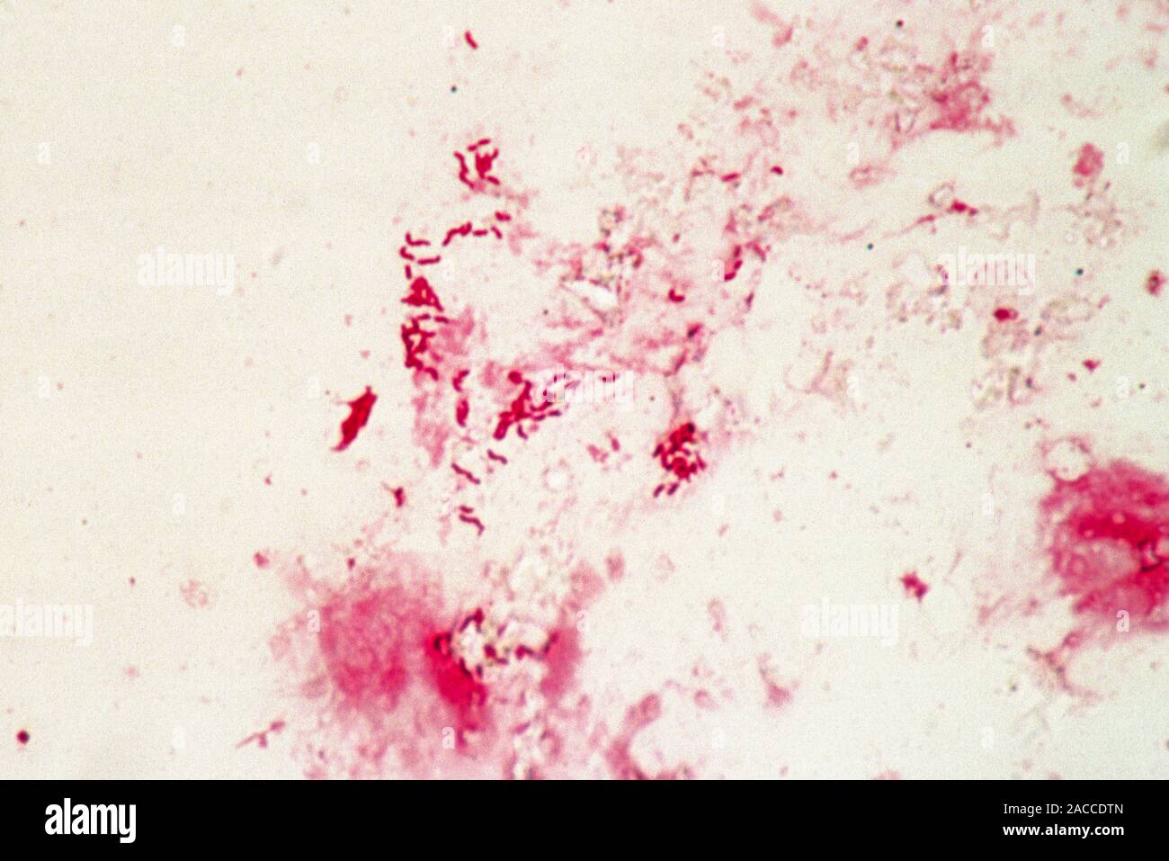 Light micrograph of a colony of the bacterium Helicobacter pylori ...