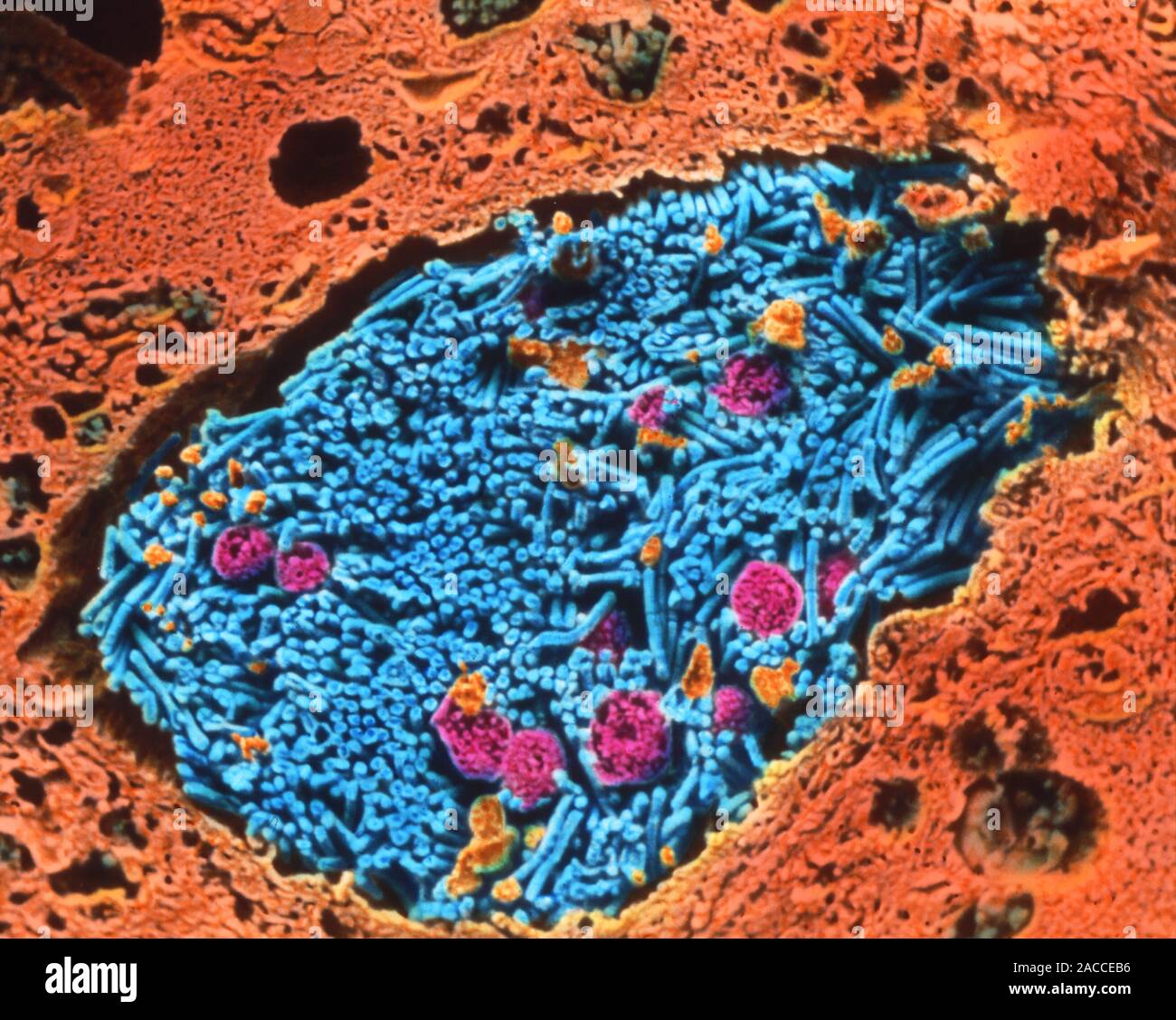 Anthrax bacteria in lung. Coloured scanning electron micrograph (SEM ...