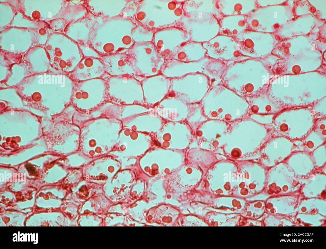 Nitrogen-fixing bacteria. Light micrograph of the cells in the nodule of a legume root ...