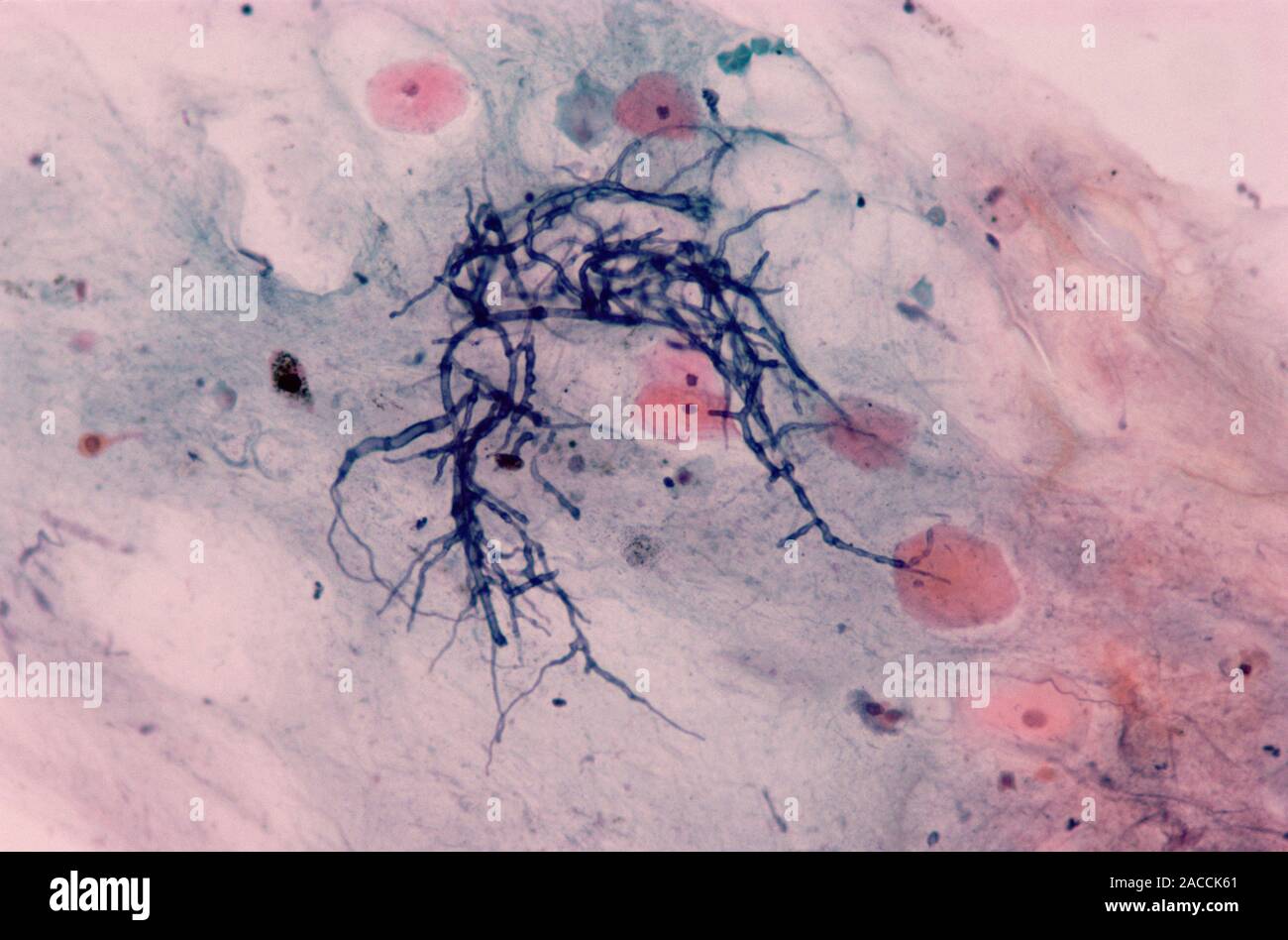 Candida fungus. Light micrograph of threads (hyphae) of the fungus ...