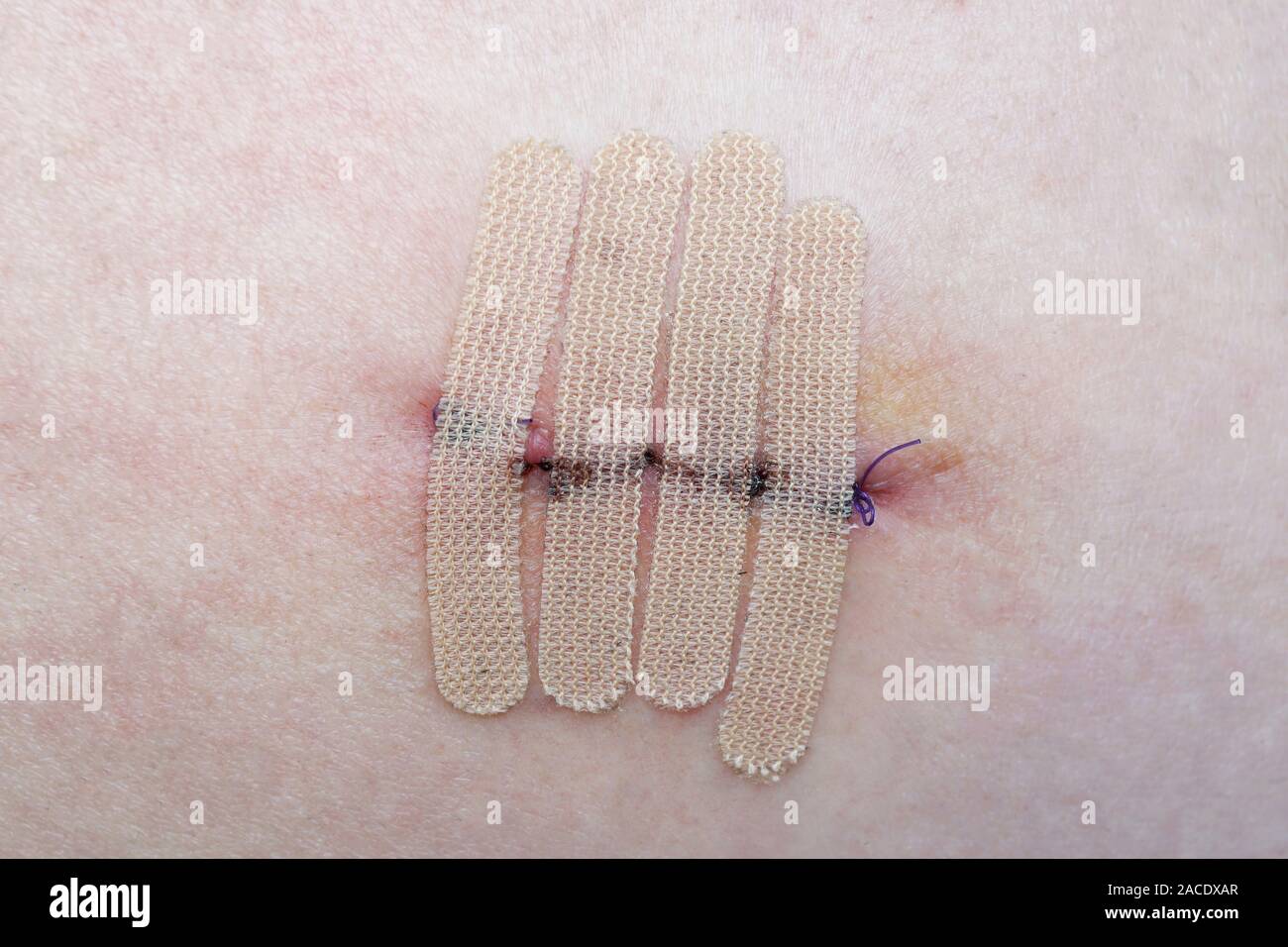 Laceration wound hi-res stock photography and images - Alamy