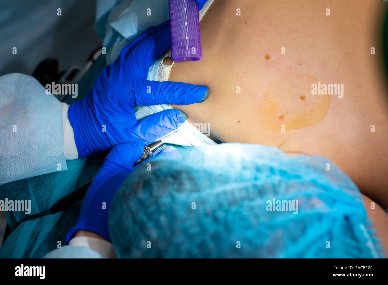 Surgeon biopsy cancer hi-res stock photography and images - Alamy