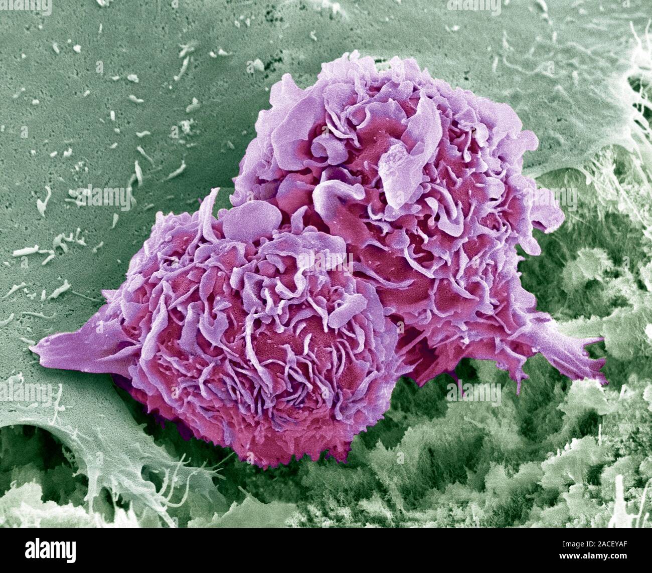 Bone cancer cells. Coloured scanning electron micrograph (SEM) of bone ...