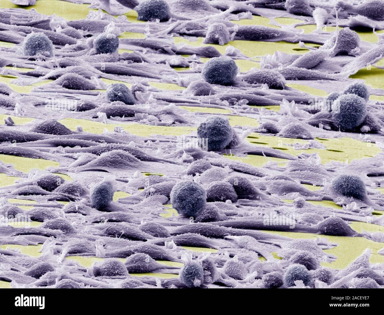 Sarcoma cancer cell culture, coloured scanning electron micrograph (SEM ...