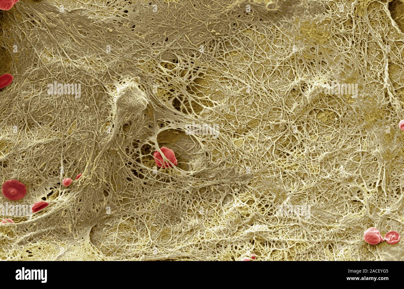 Blood clot. Coloured scanning electron micrograph (SEM) of fibrin ...