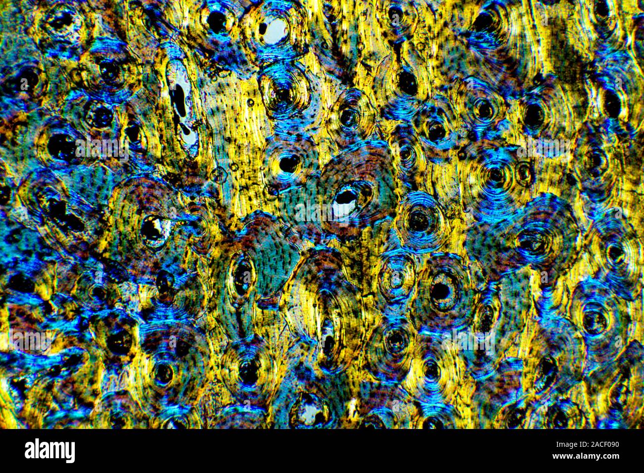 Compact bone. Polarised light micrograph of a transverse section ...