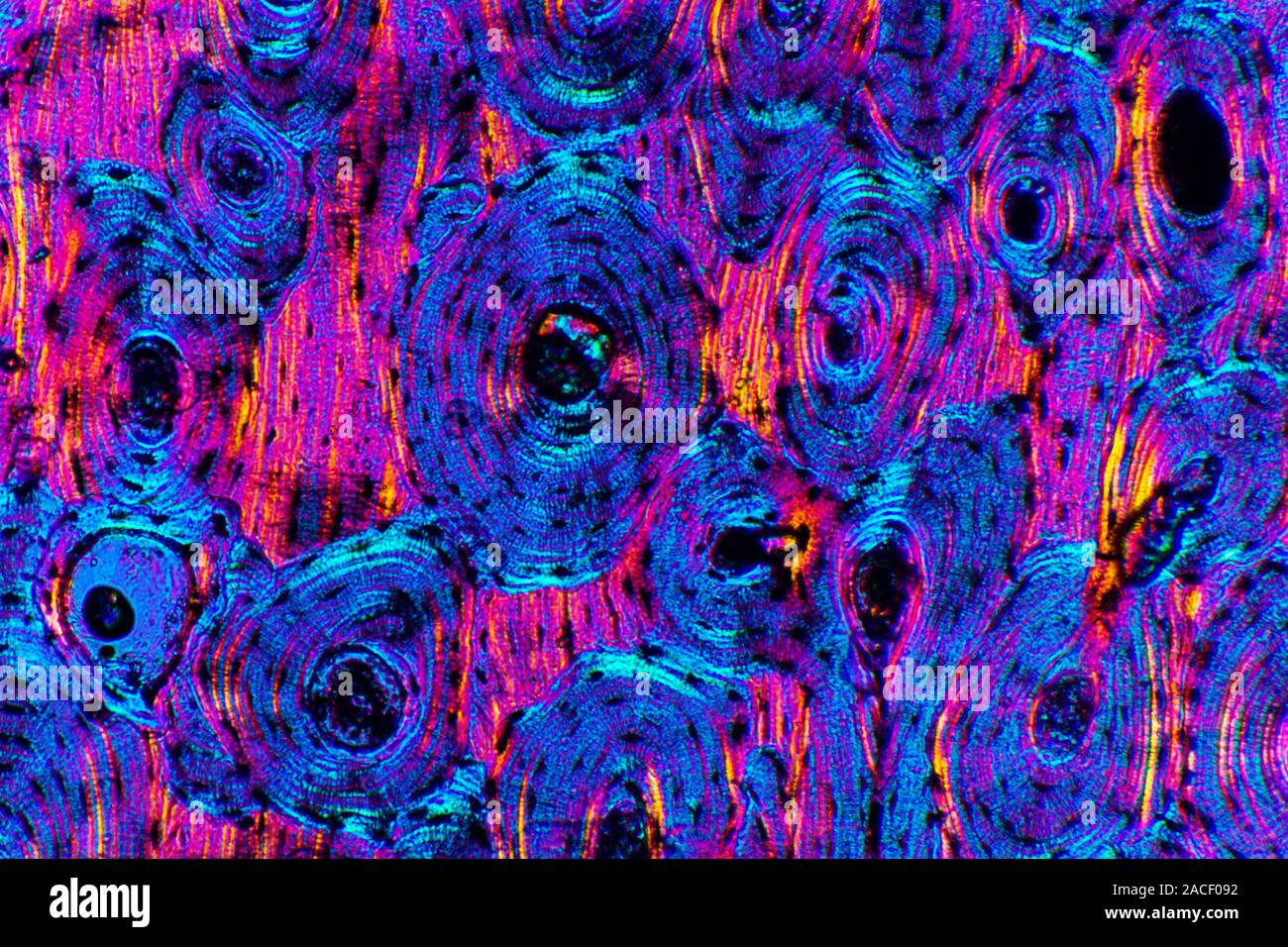 Compact bone. Polarised light micrograph of a transverse section ...