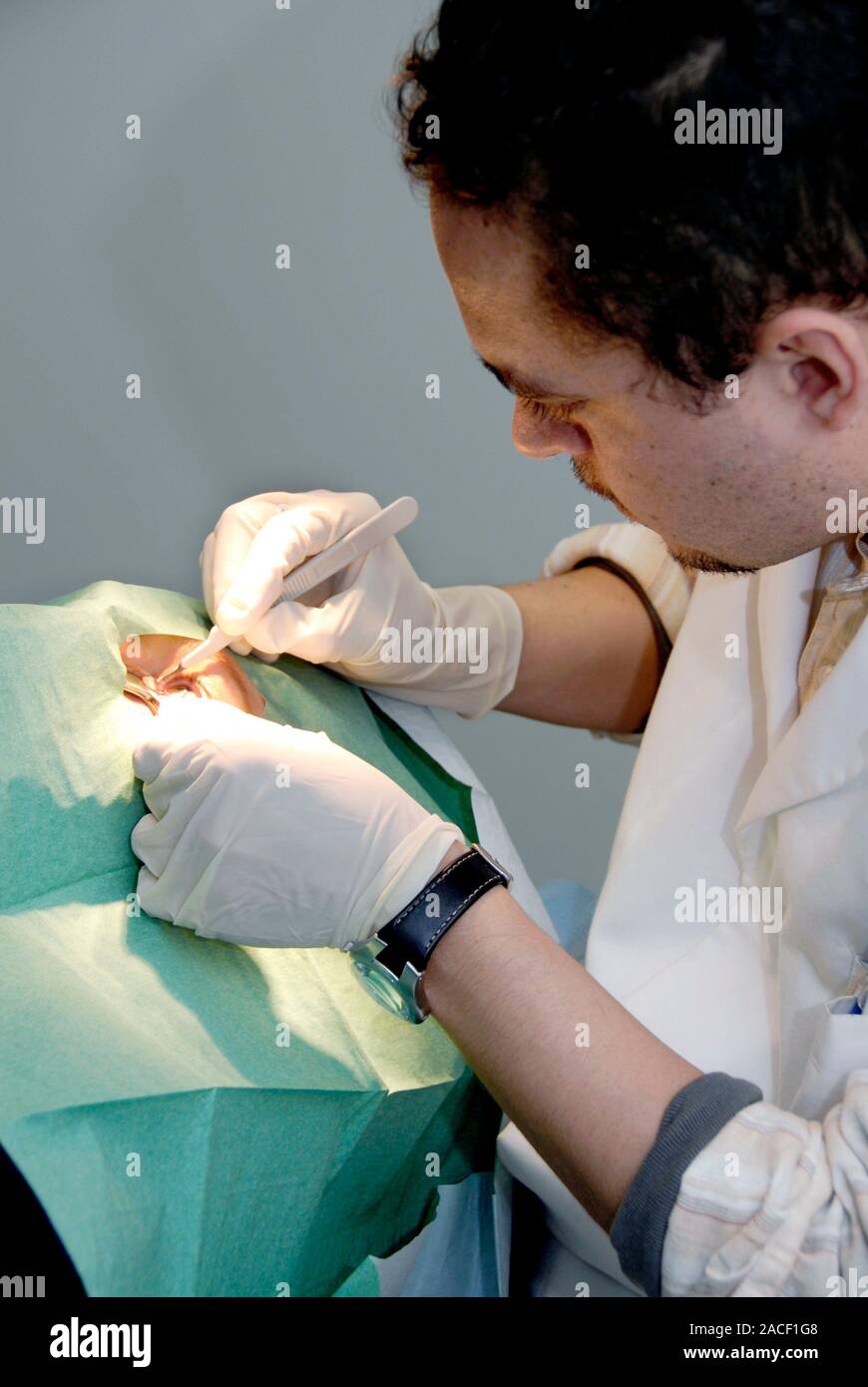 Chalazion cyst eyelid surgery. Surgeon operating to remove a chalazion ...