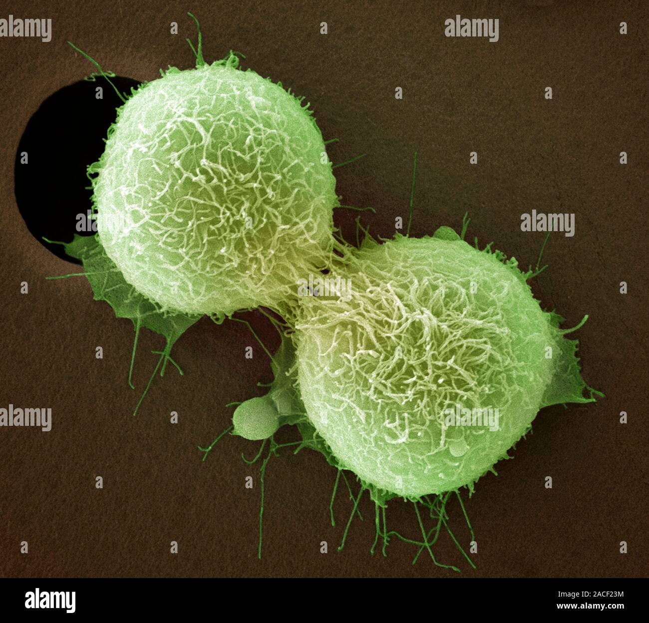 Cervical cancer cell division, coloured scanning electron micrograph ...