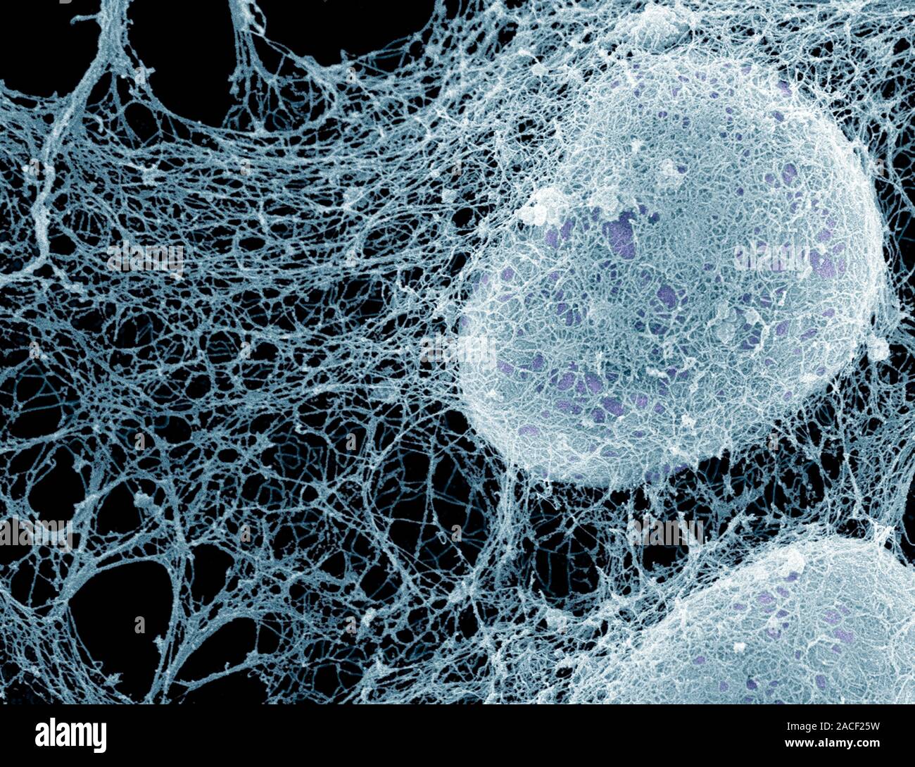 Migrating cancer cells. Coloured scanning electron micrograph (SEM) of ...