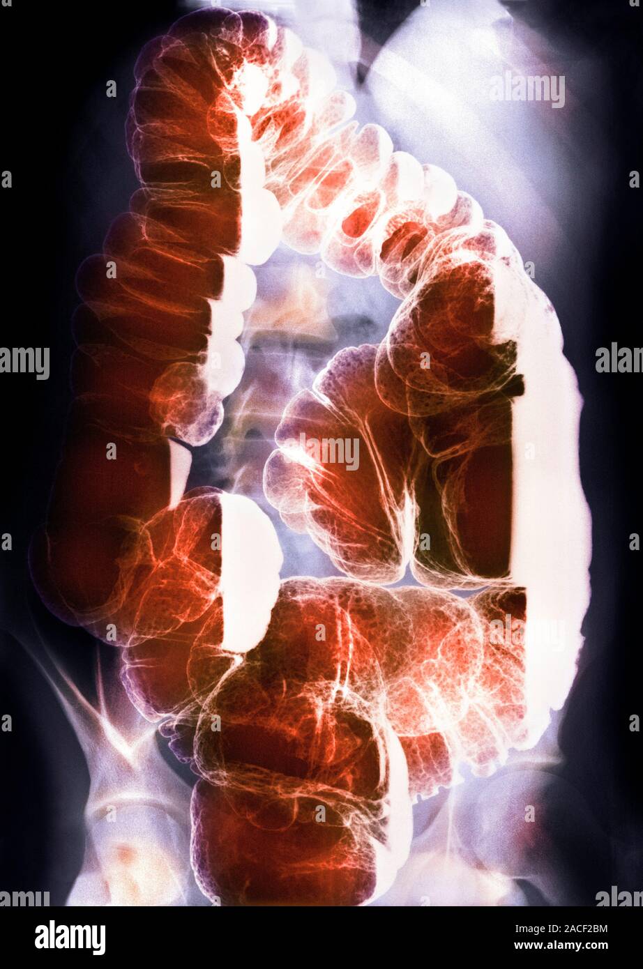 Colon polyps, coloured contrast barium enema X-ray. This X-ray of the ...