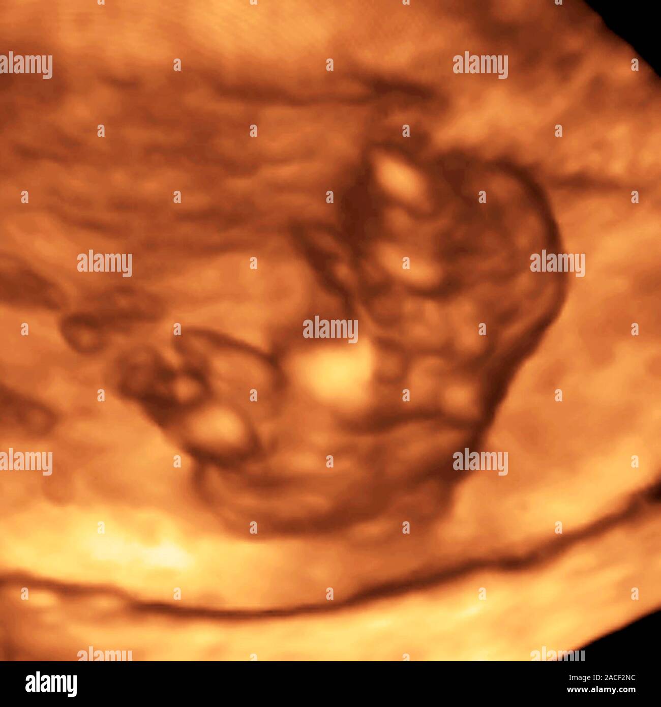 Foetus in the womb, 3D ultrasound scan. The foetus can be seen at ...