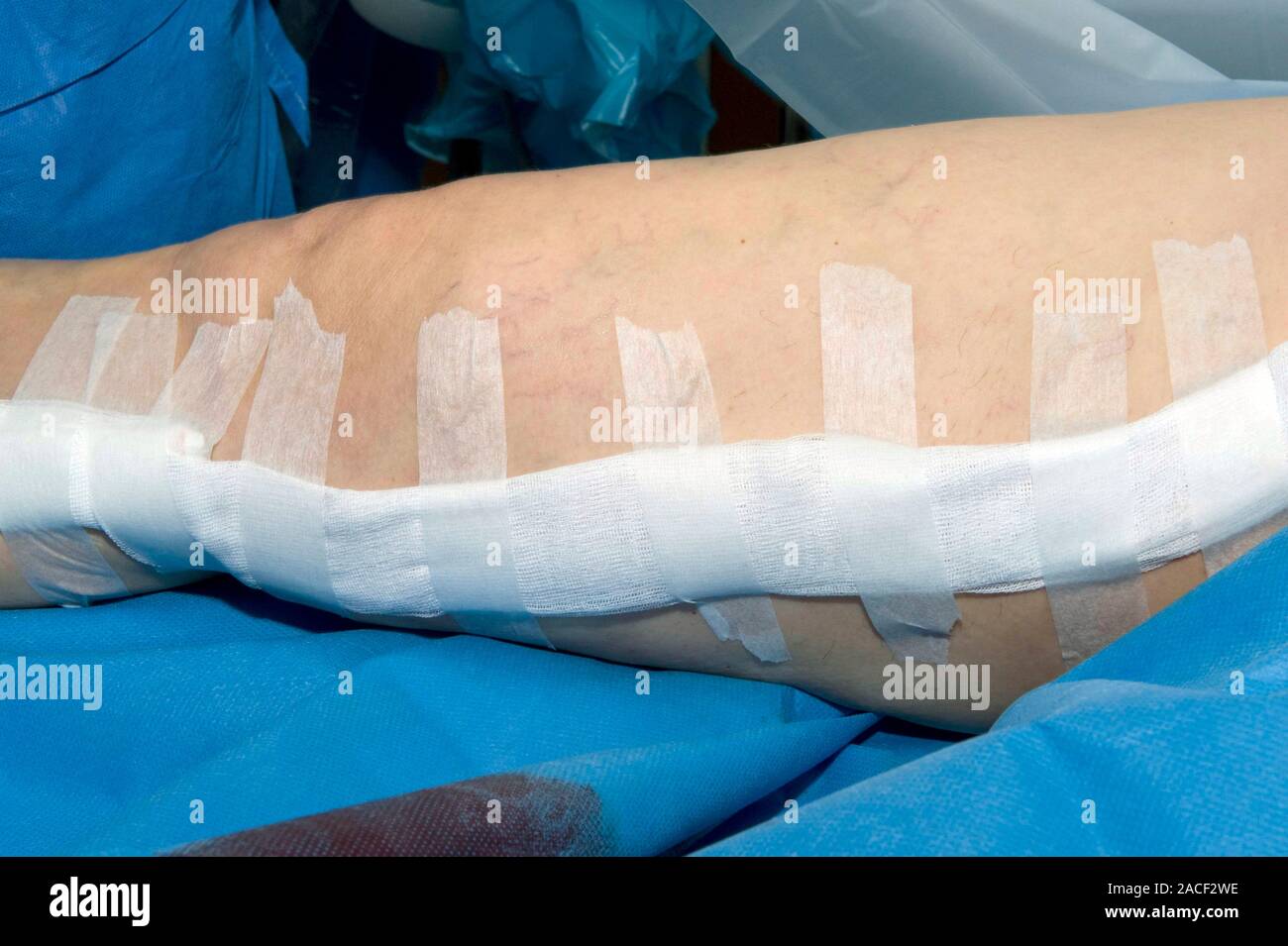 Surgical dressing. Dressing (white, horizontal) applied to the leg of a ...