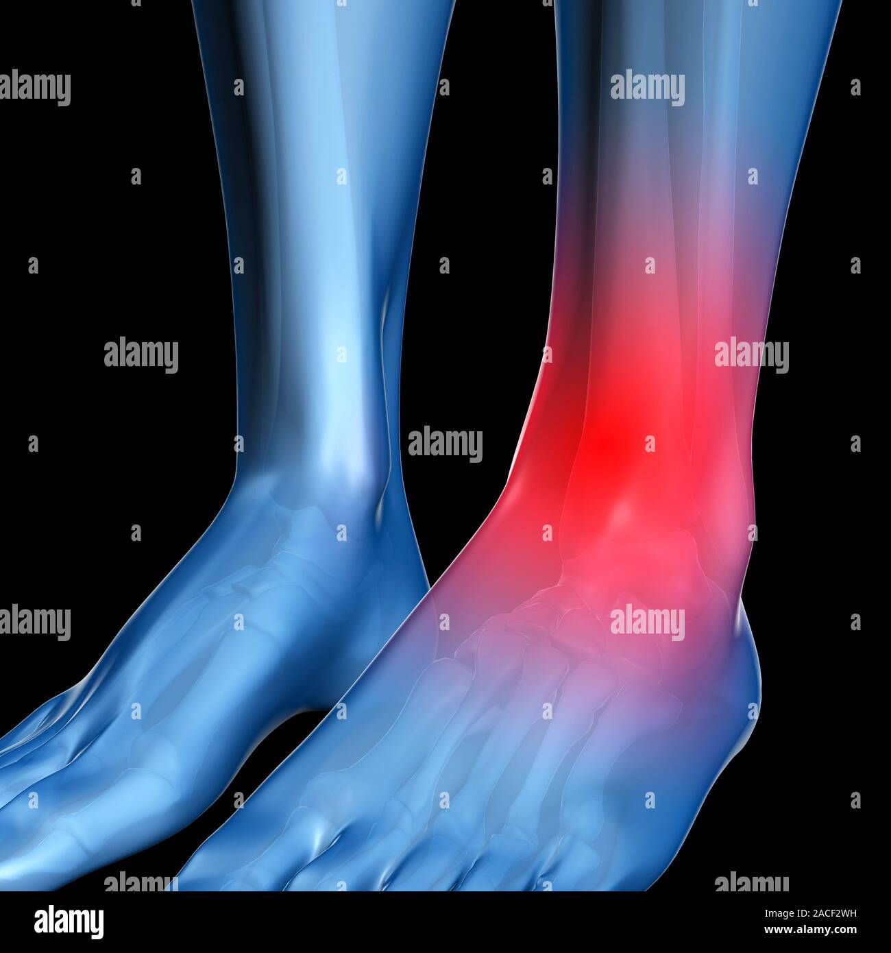Ankle pain. Conceptual computer artwork showing pain (represented as ...