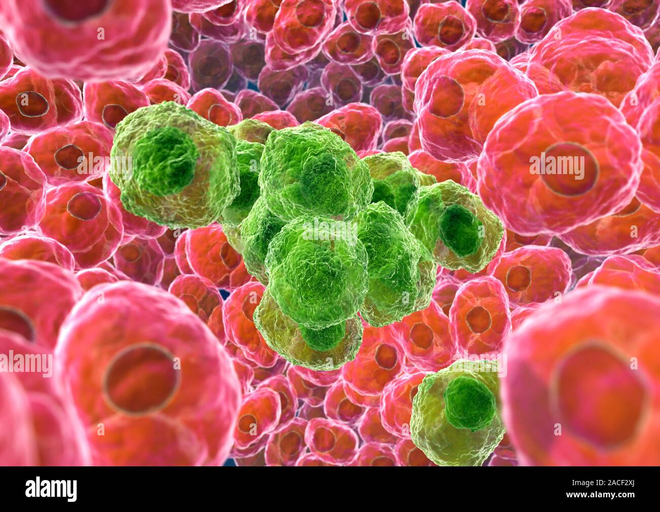 Cancer cells. Computer artwork of cancer cells (green) surrounded by ...