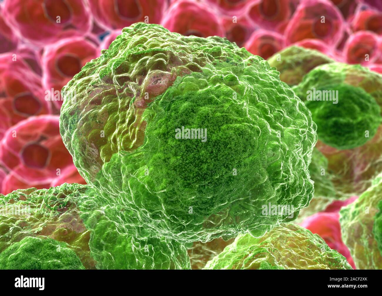 Cancer cells. Computer artwork of cancer cells (green) surrounded by ...