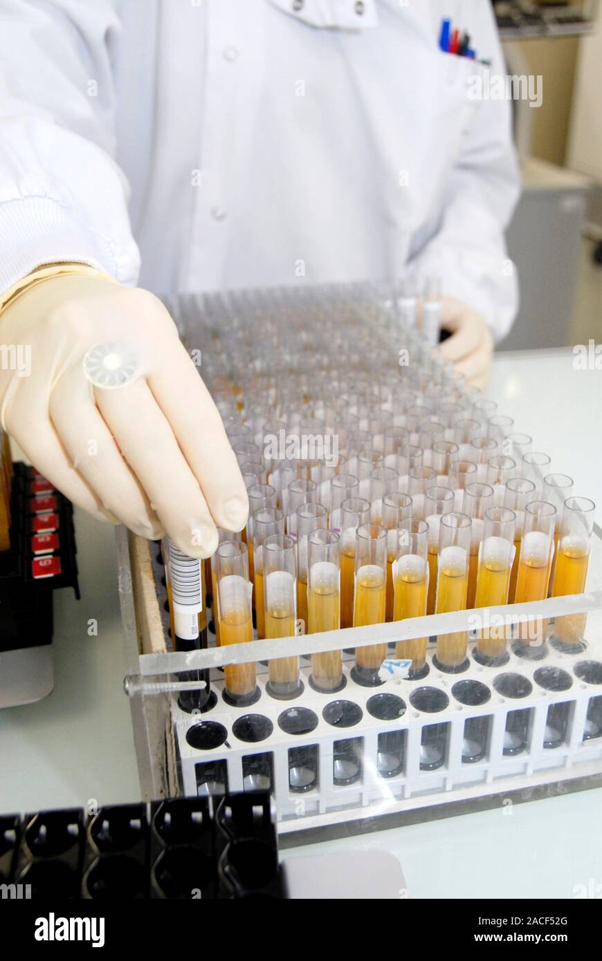 Blood analysis. Haematologist preparing samples of donated blood for ...