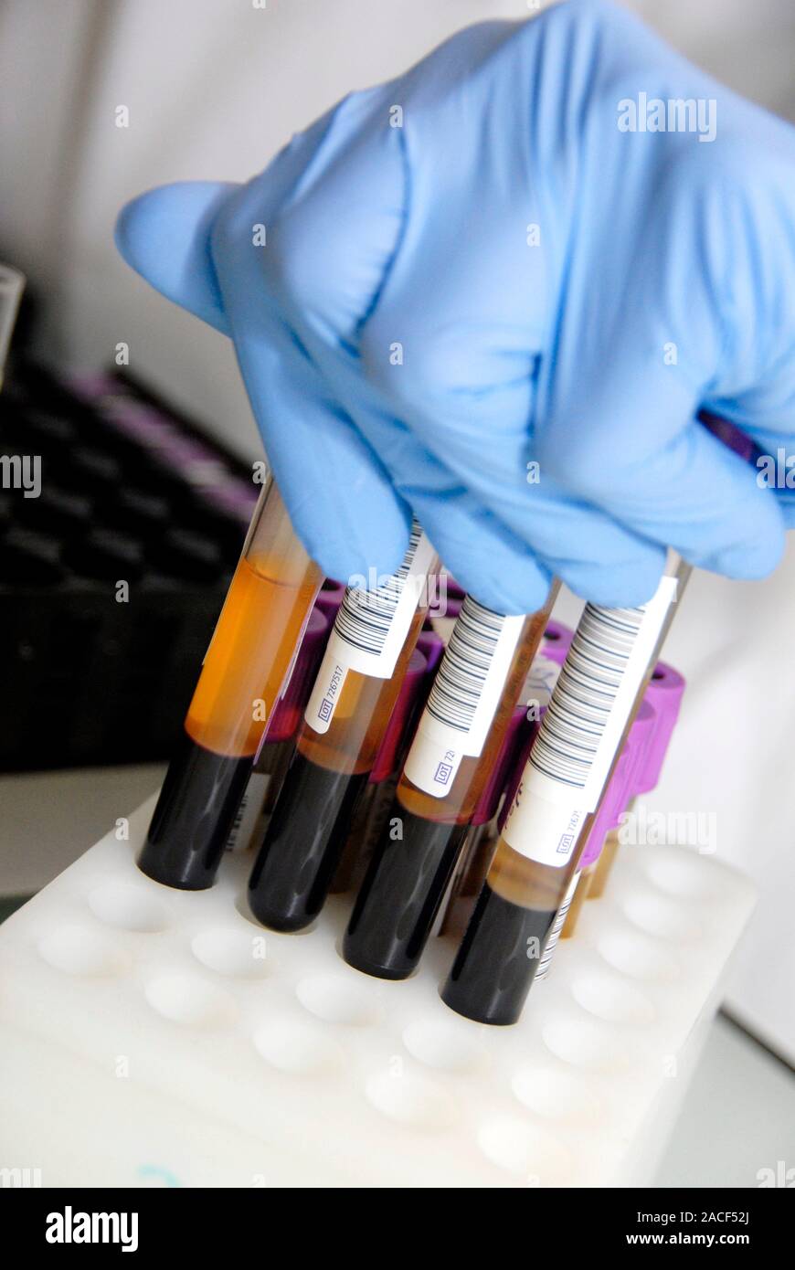 Blood analysis. Haematologist preparing samples of donated blood for ...