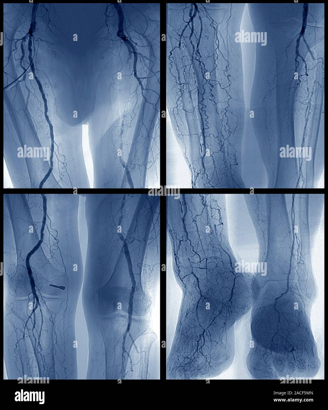 Arteritis. Coloured angiogram of the back view of the legs of a 58 year ...