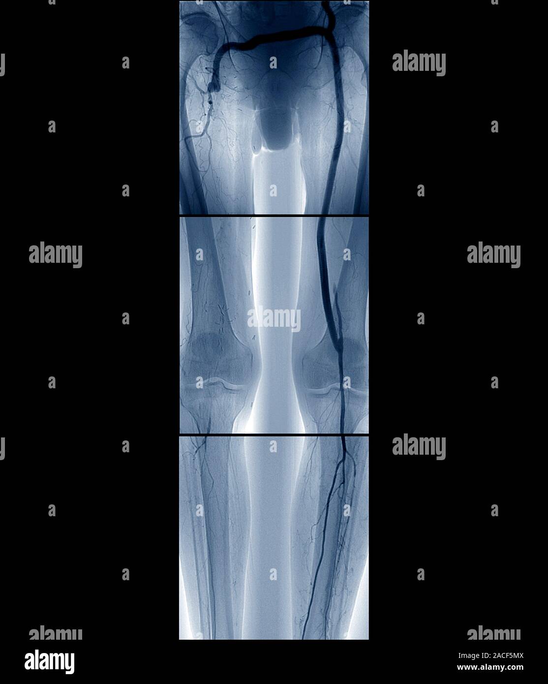 Artery bypass surgery, coloured angiogram. Back view of the legs of a ...